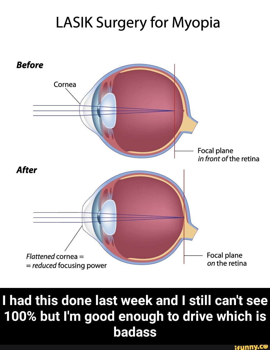 Lasik memes. Best Collection of funny Lasik pictures on iFunny