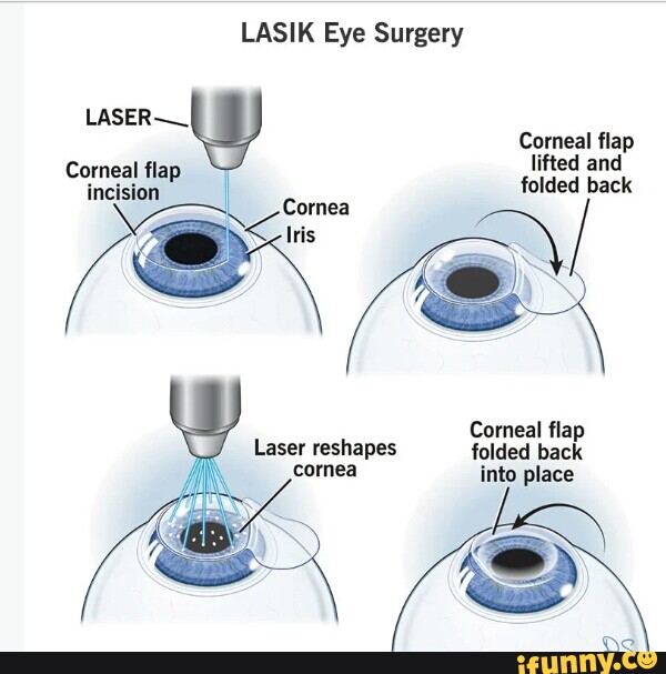 LASIK Eye Surgery Comeal flap Corneal fla lifted and incision folded ...