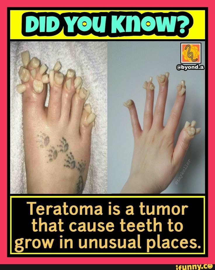 DID You Know? Teratoma is a tumor that cause teeth to grow in unusual ...
