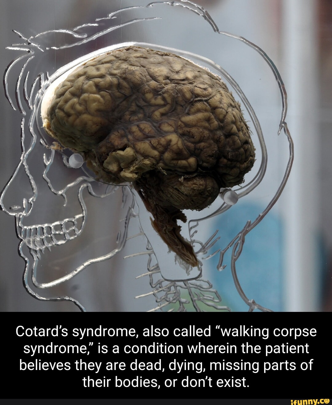 Cotard's syndrome, also called "walking corpse syndrome,' is a ...