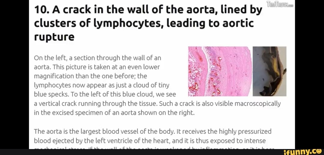 10. A crack in the wall of the aorta, lined by clusters of lymphocytes ...