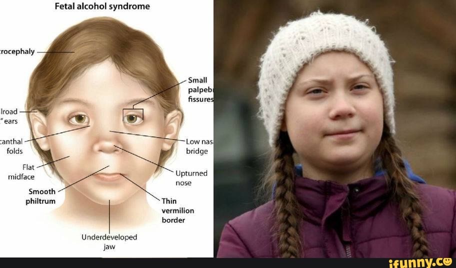 Fetal alcohol syndrome Low nas} bridge midface Upturned nose philtrum ...