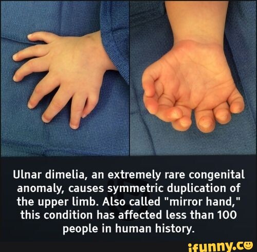 Ulnar dimelia, an extremely rare congenital anomaly, causes symmetric ...