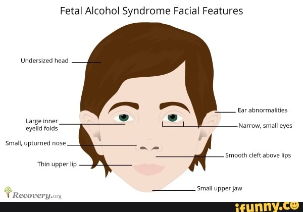 Fetal Alcohol Syndrome Facial Features Undersized head Large inner ...