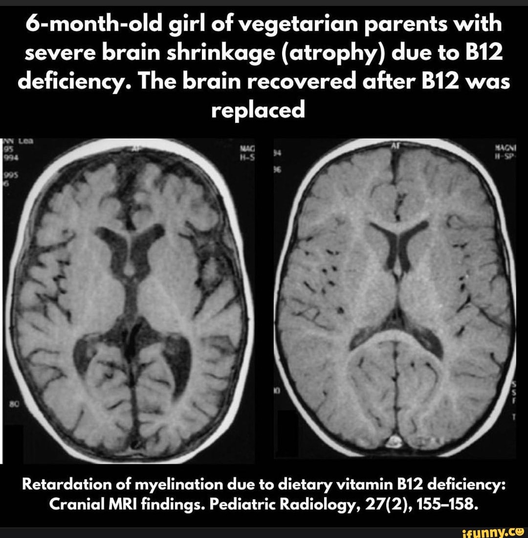 6-month-old girl of vegetarian parents with severe brain shrinkage ...