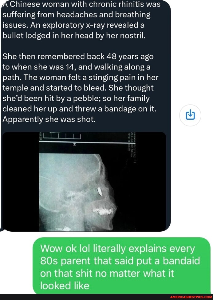 Chinese woman with chronic rhinitis was suffering from headaches and ...