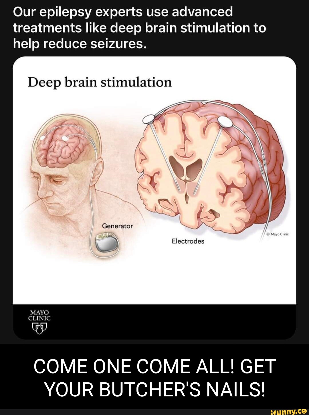 Our epilepsy experts use advanced treatments like deep brain ...
