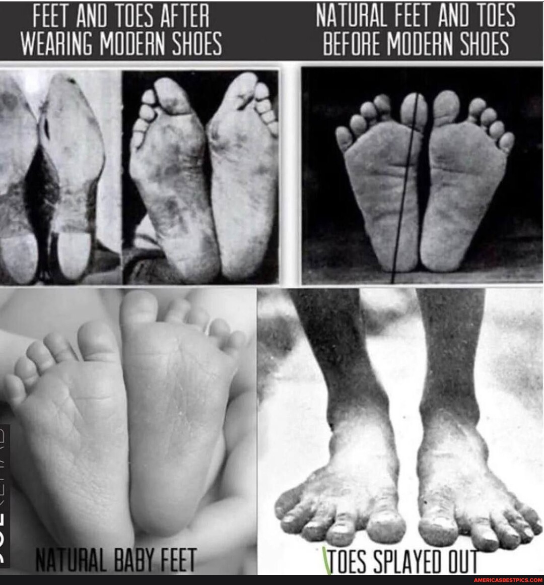 FEET AND TOES AFTER NATURAL FEET AND TOES WEARING MODERN SHOES BEFORE ...