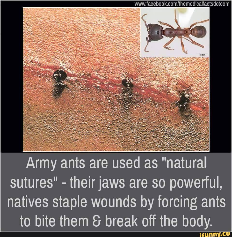 Leaving Us In Stitches - facebook .comithemedicalfactsdotcom Army ants ...