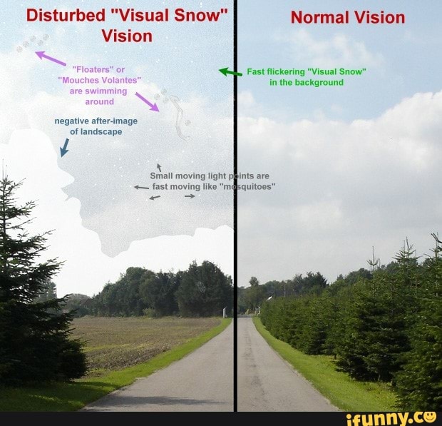 Disturbed "Visual Snow" Vision Normal Vision Fast flickering "Visual ...