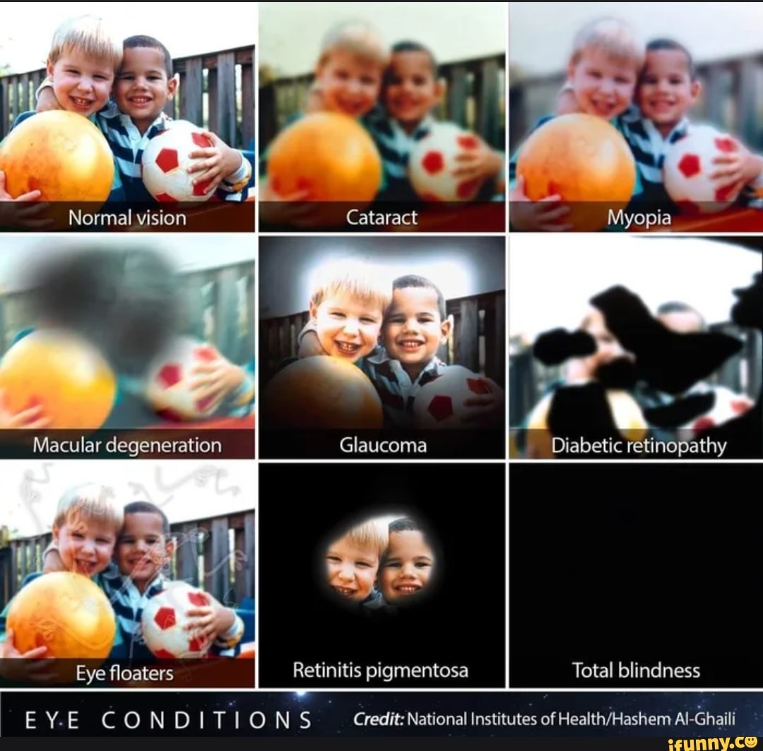 Normal Vision Cataract Myopia Macular Degeneration Glaucoma Diabetic Re Normal Vision Cataract Myopia Macular Degeneration Glaucoma Diabetic Re