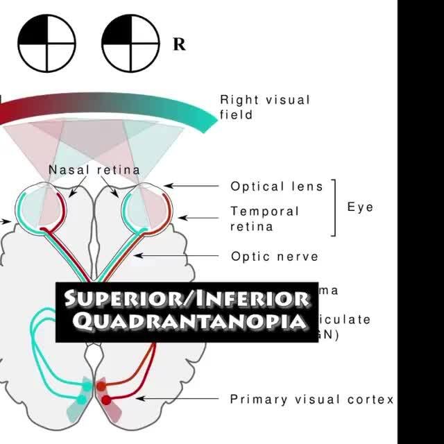 Field A Optical lens Temporal Eye retina Optic nerve Primary visual ...