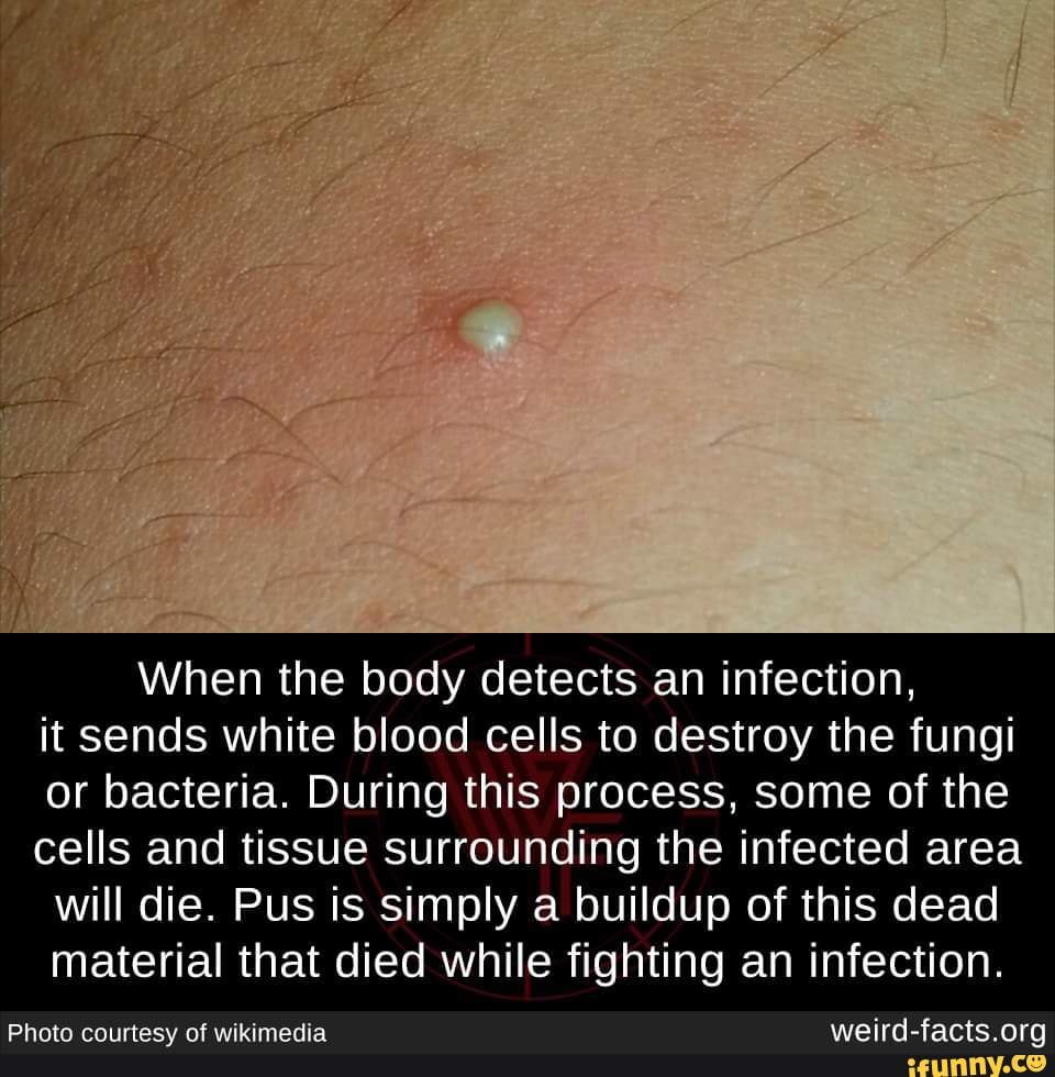 When the body detects an infection, it sends white blood cells to ...