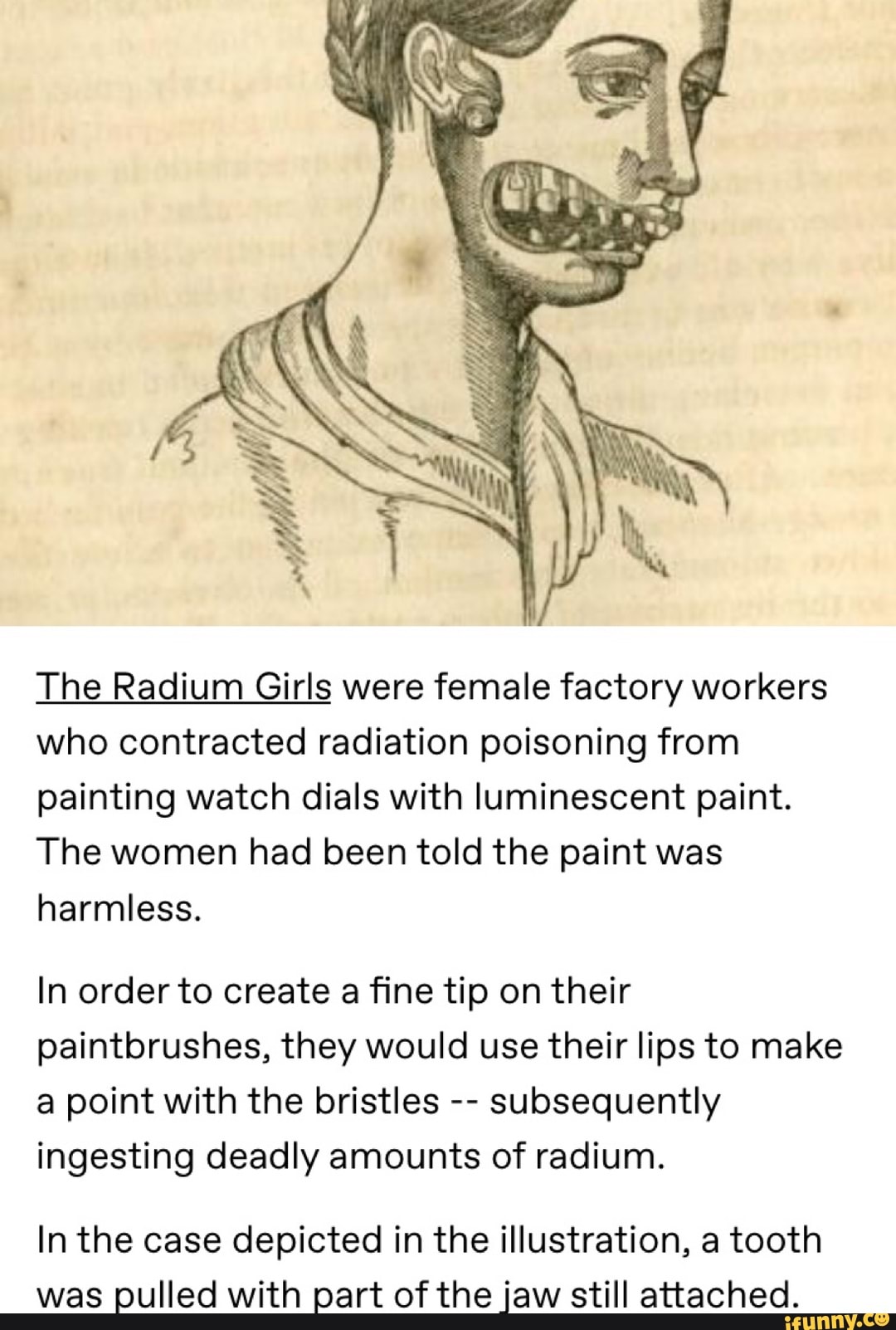 The Radium Girls were female factory workers who contracted radiation ...
