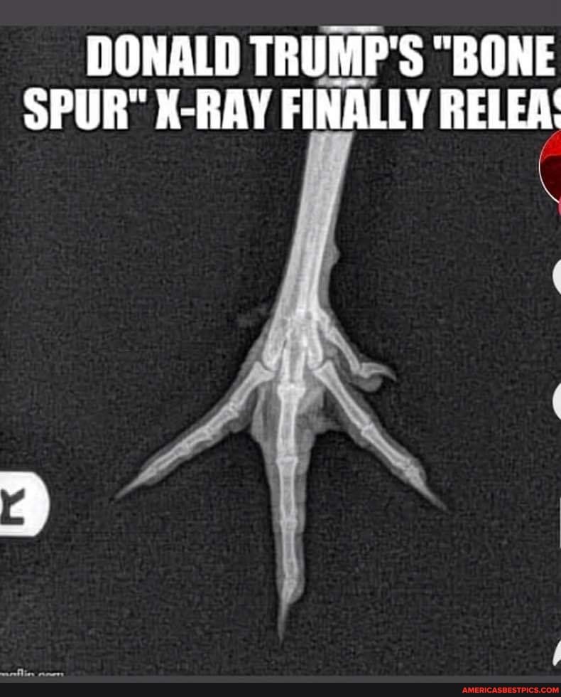 DONALD TRUMP'S "BONE SPUR" X-RAY FINALLY RELEA! - America’s best pics ...
