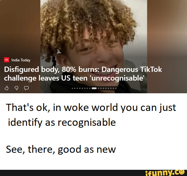 India Today Disfigured body, 80% burns: Dangerous TikTok challenge ...