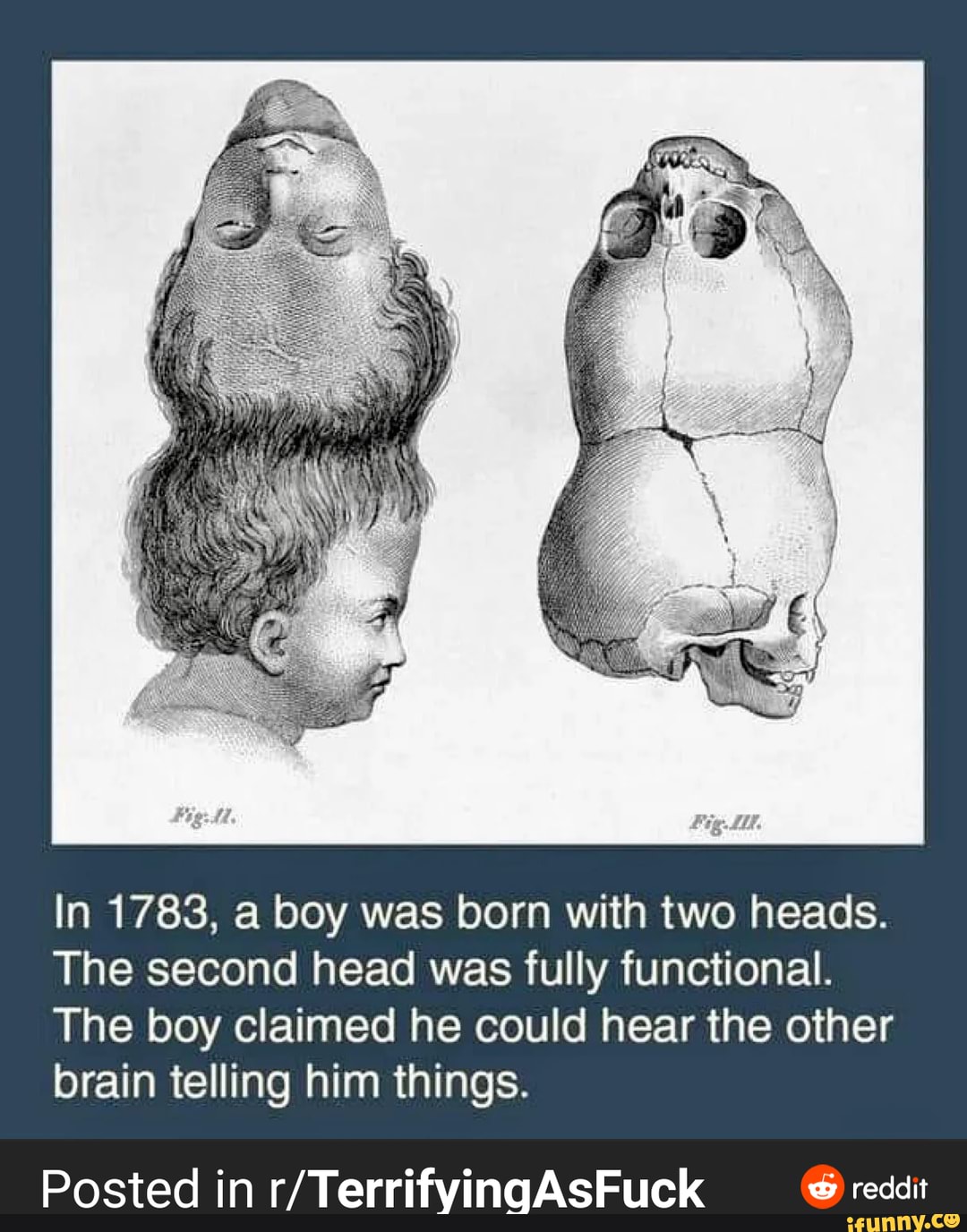 In 1783, a boy was born with two heads. The second head was fully ...