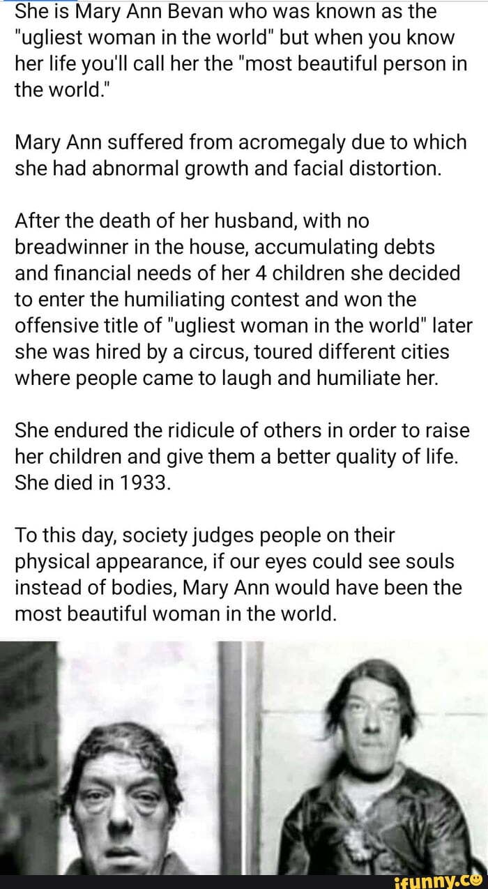 Acromegaly memes. Best Collection of funny Acromegaly pictures on iFunny