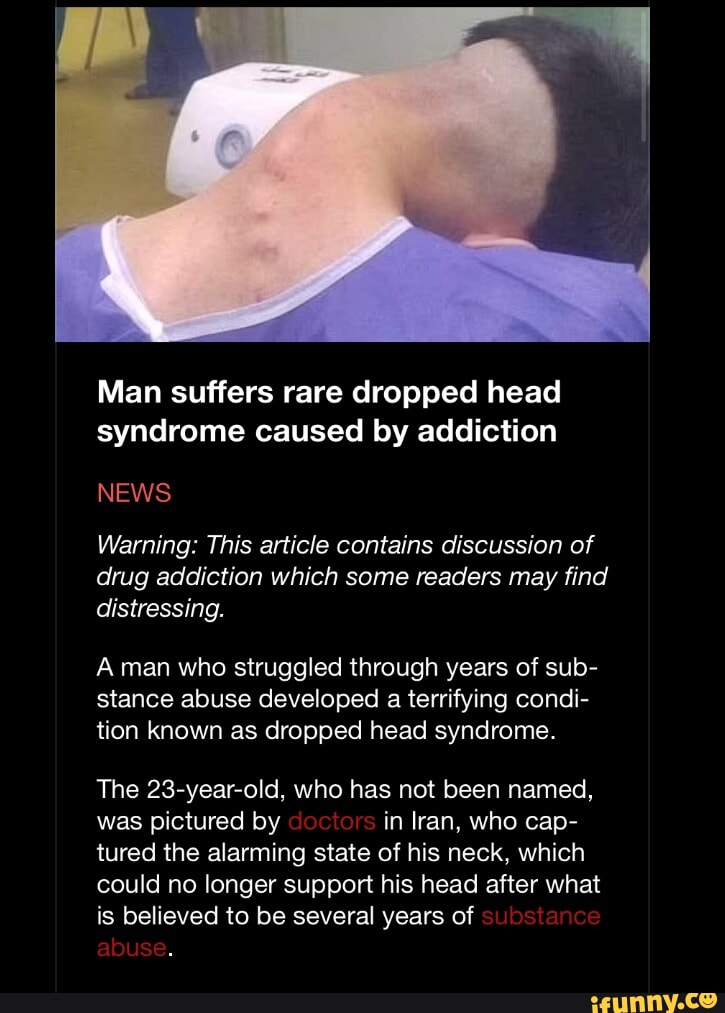Man suffers rare dropped head syndrome caused by addiction NEWS Warning ...