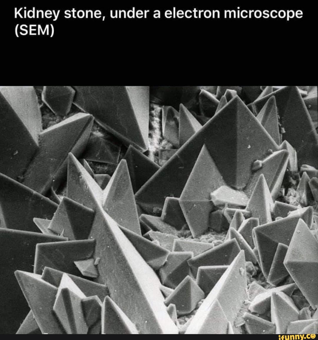 Kidney stone, under a electron microscope - seo.title
