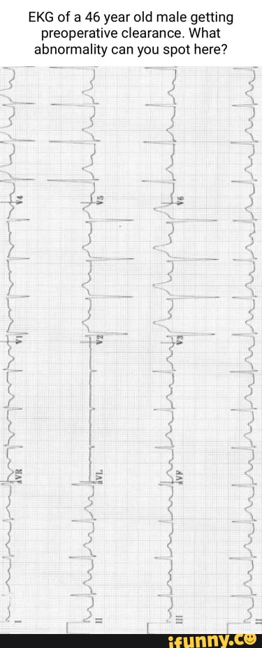 EKG memes. Best Collection of funny EKG pictures on iFunny