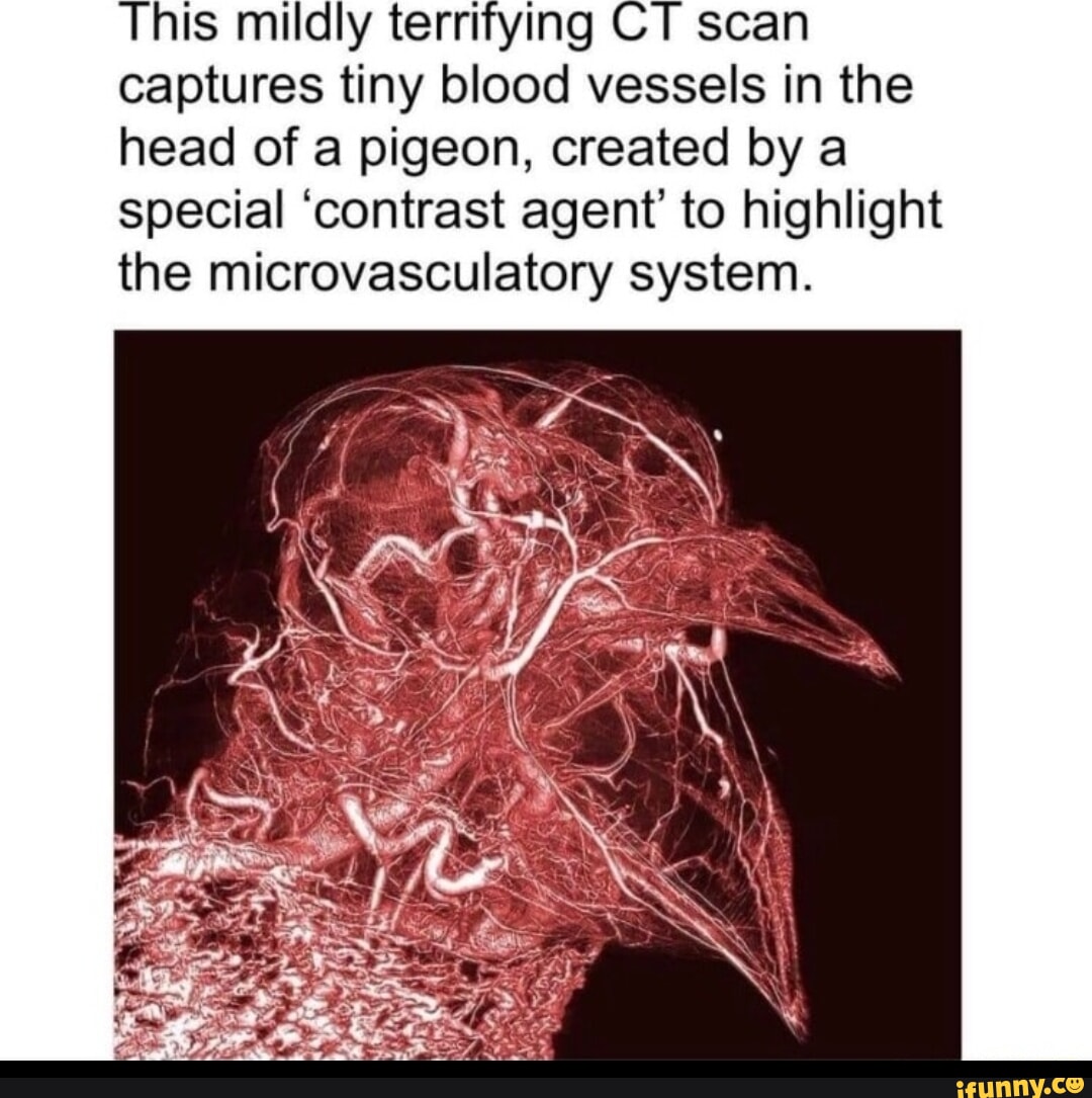 This mildly terrifying CT scan captures tiny blood vessels in the head ...