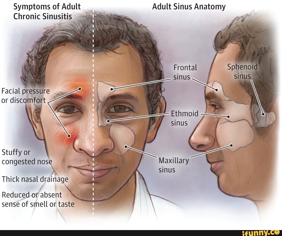 Symptoms of Adult Adult Sinus Anatomy Chronic Sinusitis Frontal sinus ...
