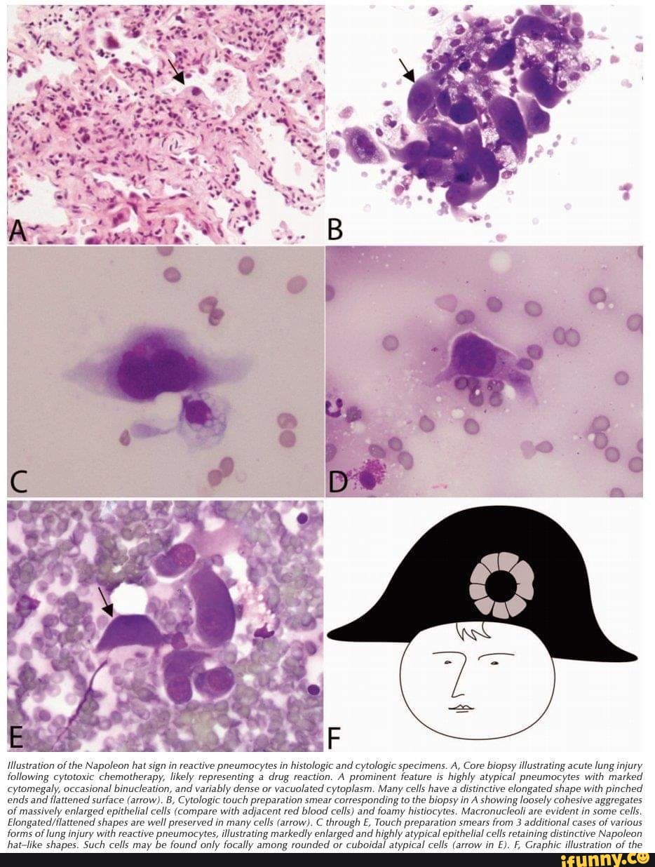 AD wes av Illustration of the Napoleon hat sign in reactive pneumocytes ...
