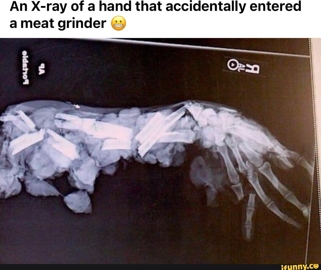 An X-ray of a hand that accidentally entered a meat grinder - iFunny