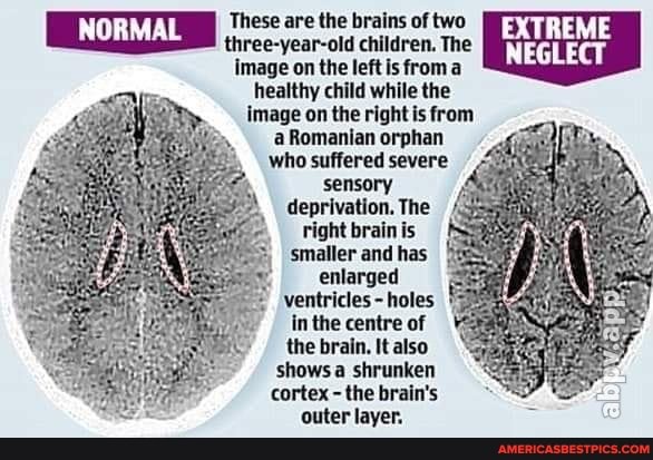 These are the brains of two three-year-old children. The image on the ...