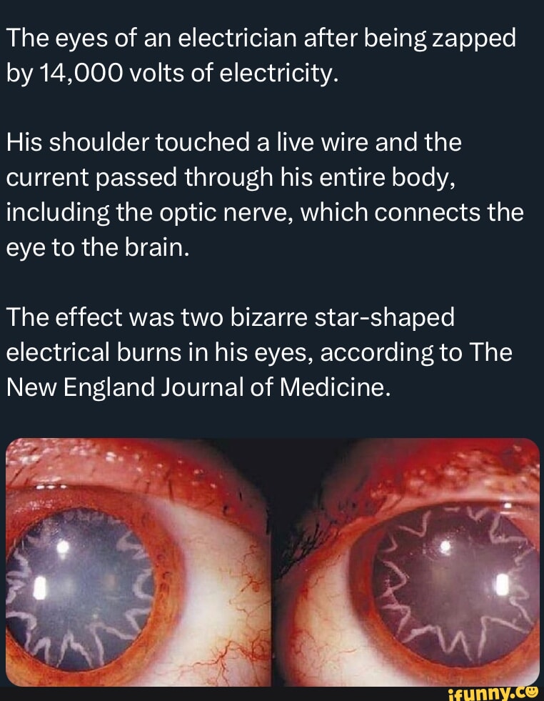 The eyes of an electrician after being zapped by 14,000 volts of ...