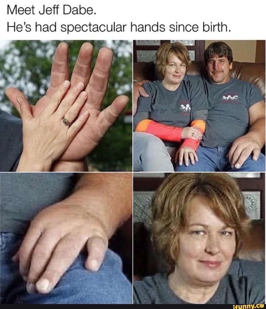Meet Jeff Dabe. He's had spectacular hands since birth. I I - iFunny