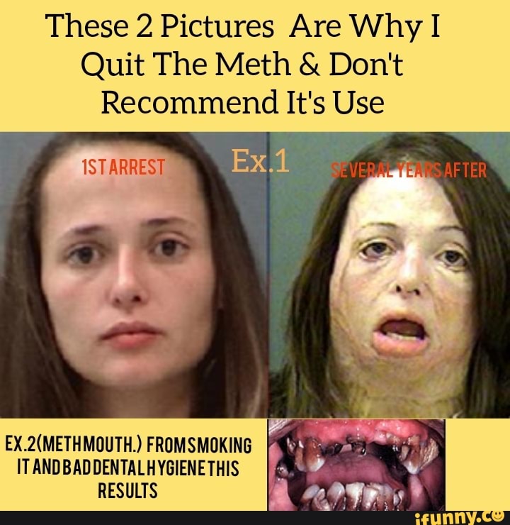 These 2 Pictures Are Why I Quit The Meth & Don't Recommend It's Use Ex ...