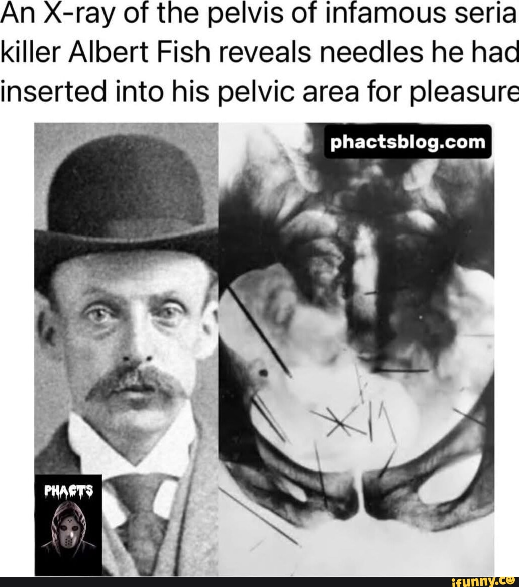 An X-ray of the pelvis of infamous seria killer Albert Fish reveals ...