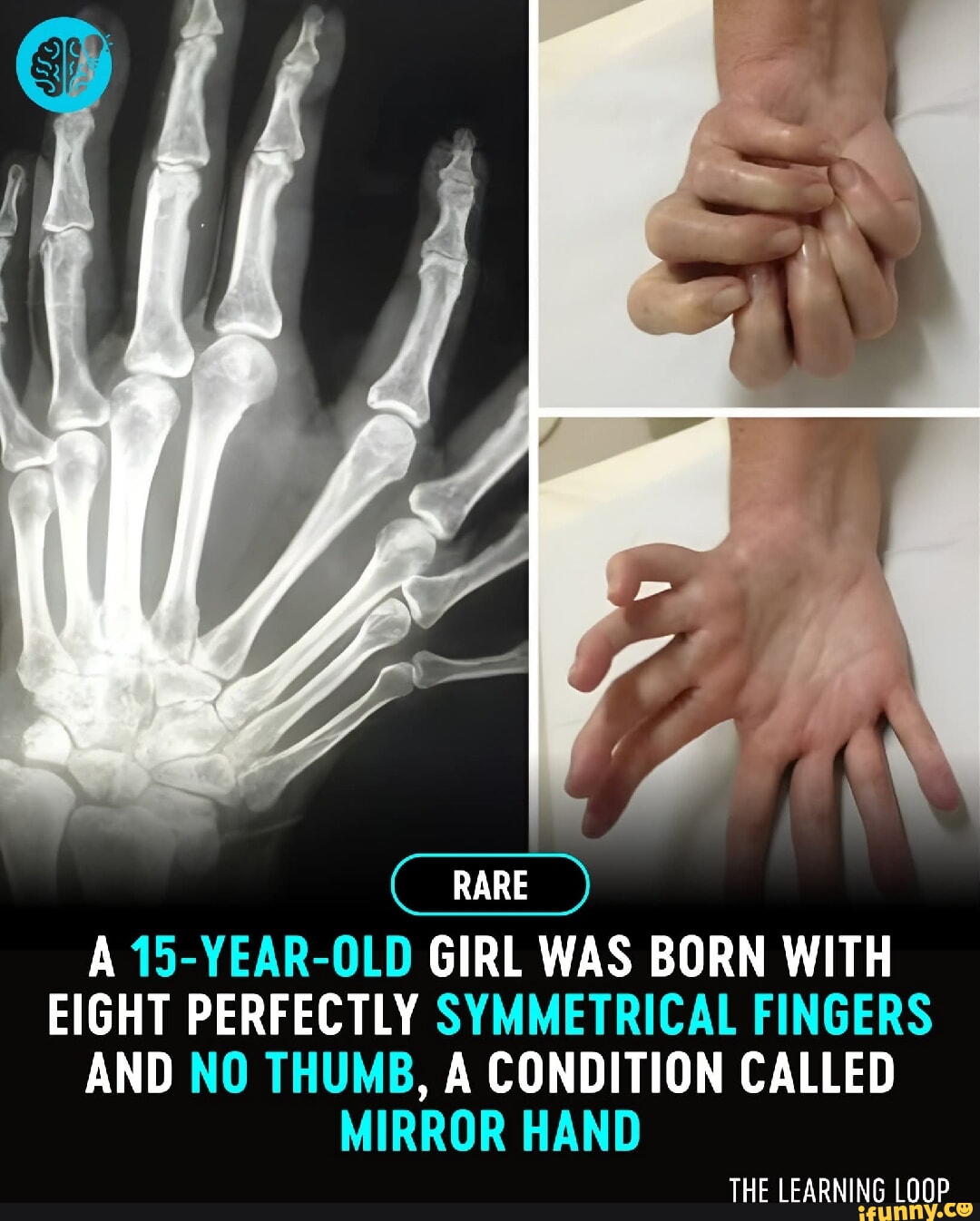 RARE A 15-YEAR-OLD GIRL WAS BORN WITH EIGHT PERFECTLY SYMMETRICAL ...