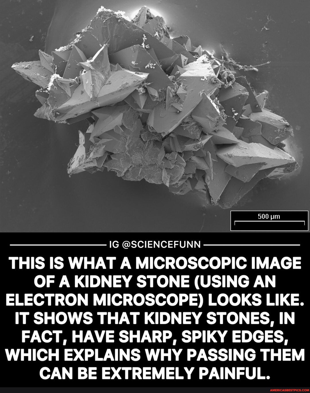 Kidney stones are crystalline structures formed from minerals and salts ...