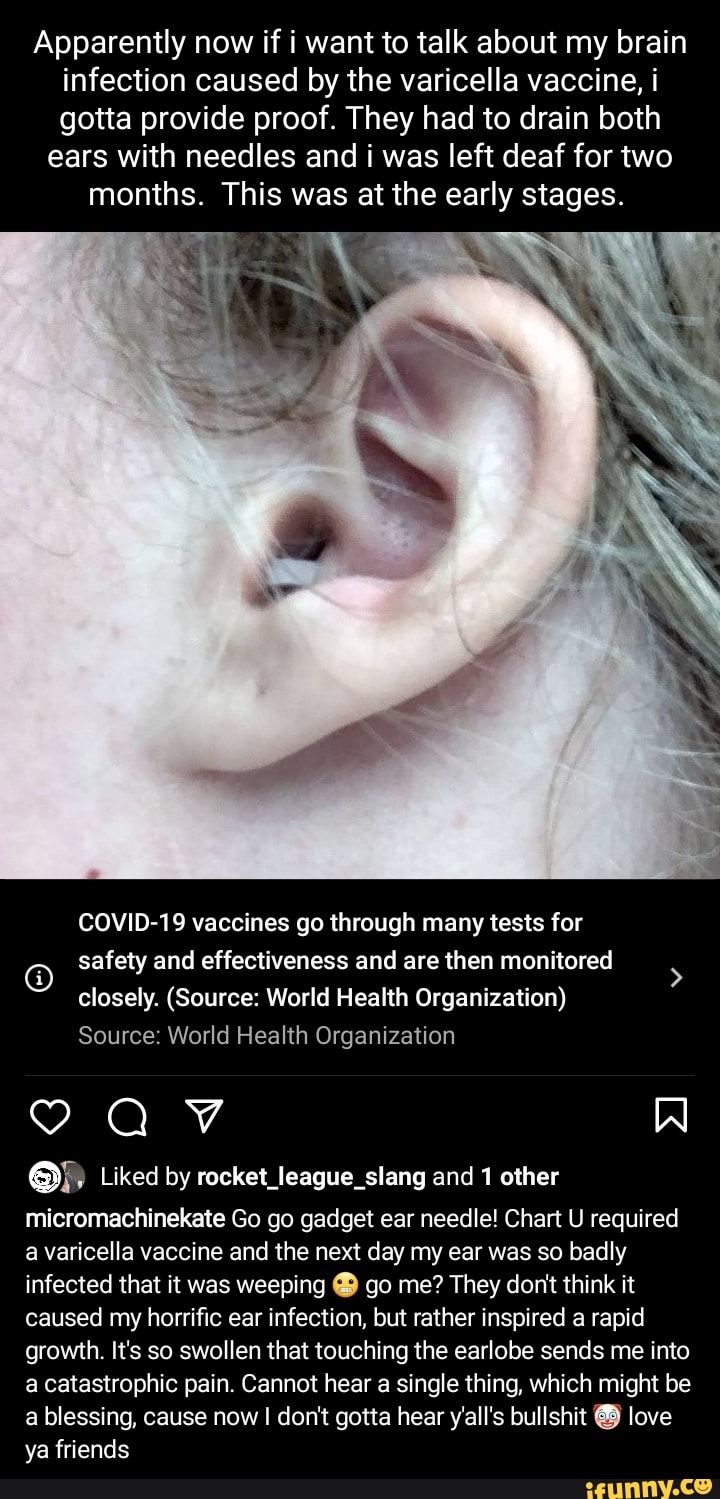 Varicella memes. Best Collection of funny Varicella pictures on iFunny