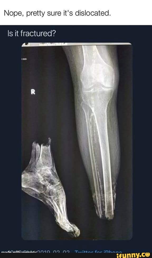 Nope, pretty sure it's dislocated. ls it fractured? - iFunny