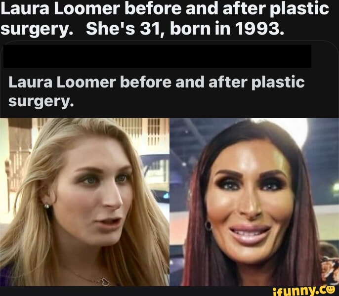 Laura Loomer before and after plastic surgery. She's 31, born in 1993 ...