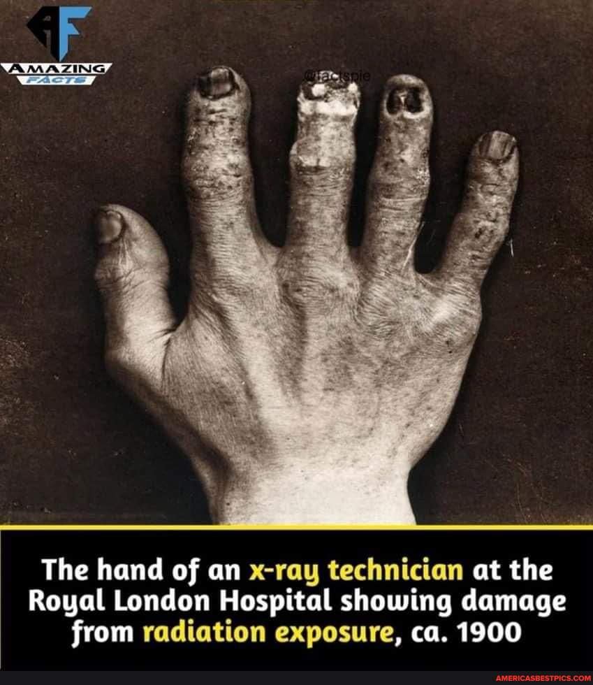 ZING, gee The hand of an x-ray technician at the Royal London Hospital ...