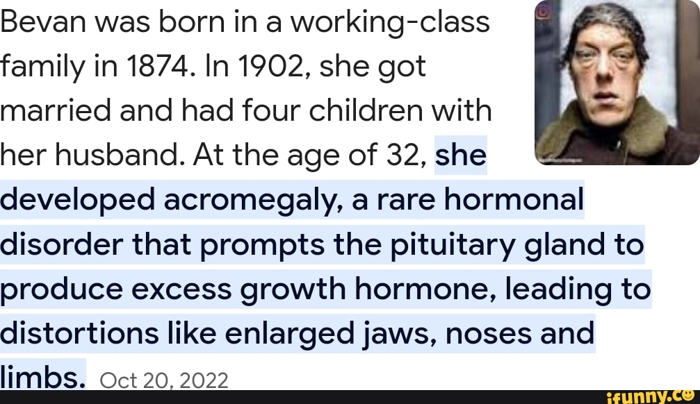 Acromegaly memes. Best Collection of funny Acromegaly pictures on iFunny