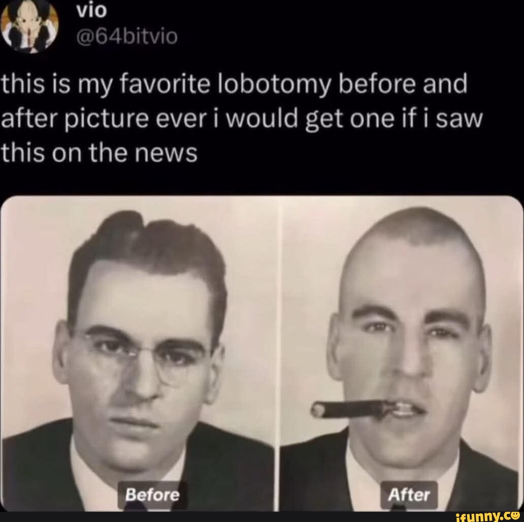 @64bivo this is my favorite lobotomy before and after picture ever i ...