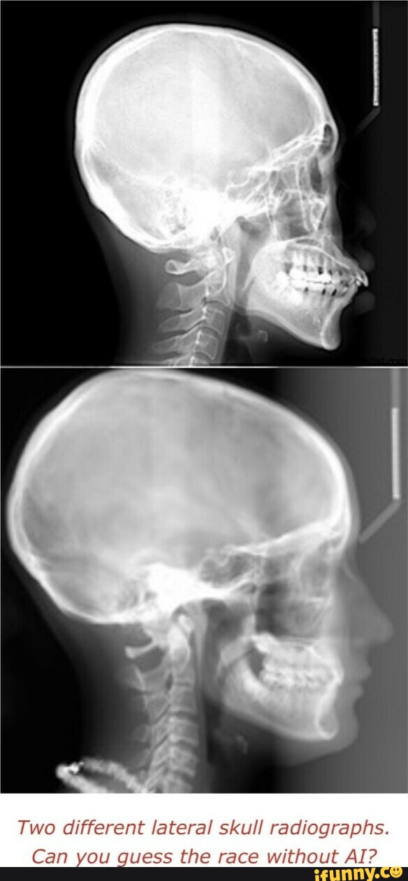 Two different lateral skull radiographs. Can you guess the race without ...
