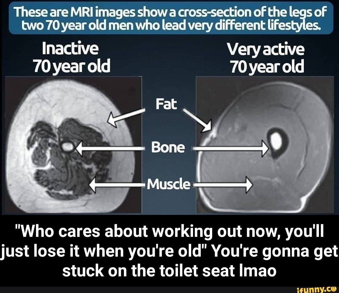 These are MRI images show a cross-section of the legs of two 70 year ...