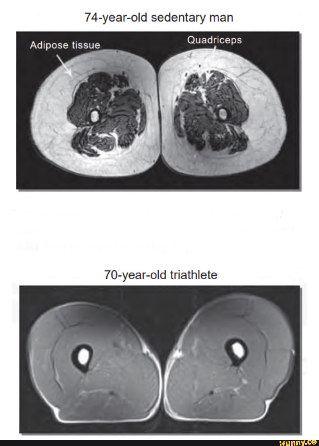 74-year-old sedentary man Quadriceps Adipose tissue 70-year-old ...