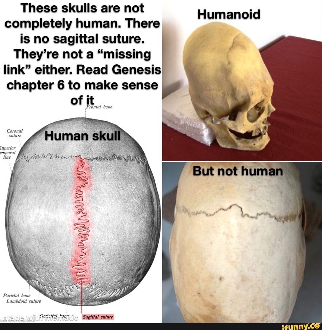 These skulls are not completely human. There is no sagittal suture ...