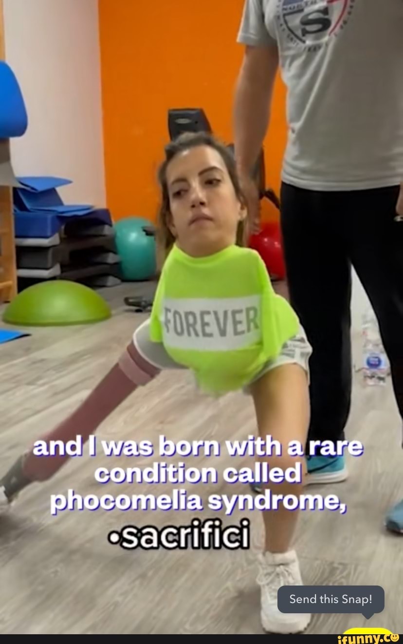 And! was born with arare condition called phocomelia syndrome, I Send ...