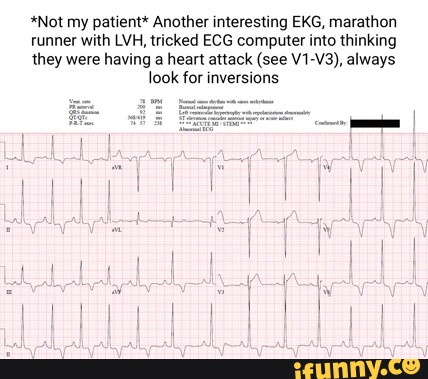 *Not my patient* Another interesting EKG, marathon tunner with LVH ...