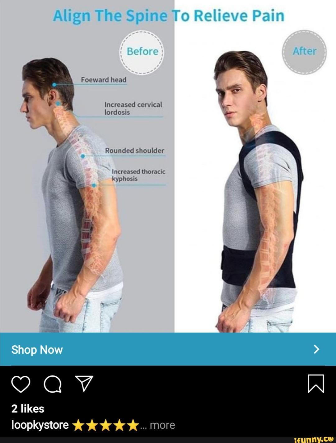 Foeward head Increased cervical { lordosis Rounded shoulder Increased ...