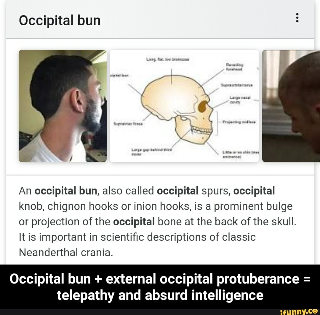 Occipital bun An occipital bun, also called occipital spurs, occipital ...